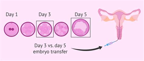 Acupuncture Use Before Embryo Transfer Supporting Fertility