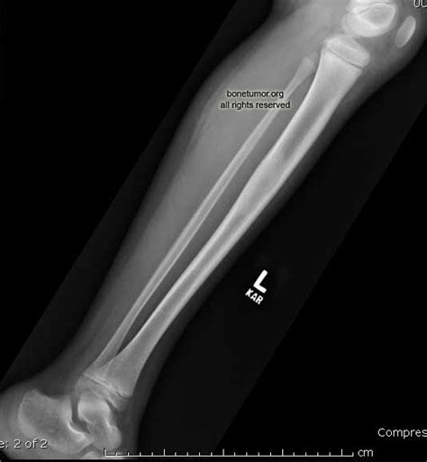 A Tibia Tumor In An 8 Year Old Boy