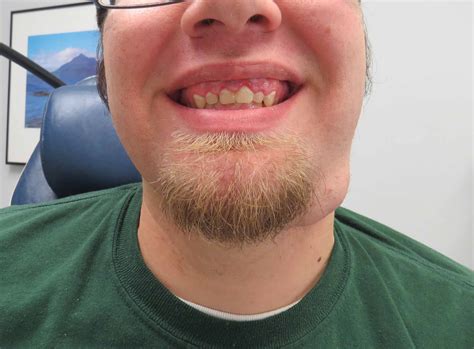 Marginal Mandibular Nerve Weakness Ramus Mandibularis Level I Neck