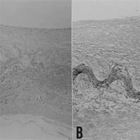 Histological Findings In Patch Grafts Of Intermediate Portion 4 Months
