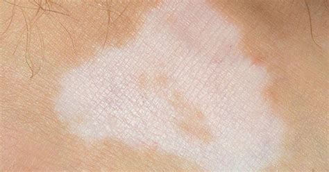 Patch Spots On Skin At Henry Briggs Blog