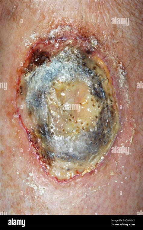 Pyoderma Ulcer On The Skin Of A 60 Year Old Diabetic Man This Is