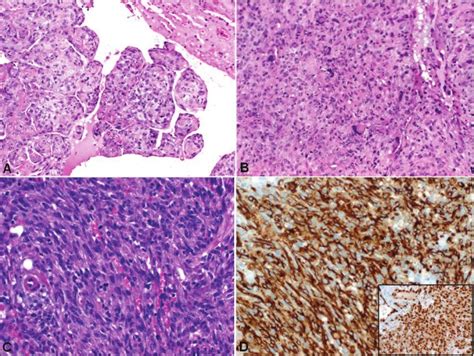 Primary And Metastatic Cardiac Sarcomas A 12 Year Experience At A