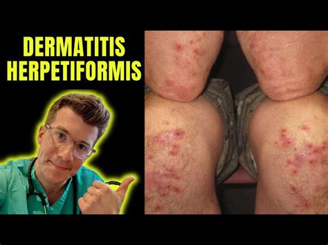 Gluten Rash On Fingers