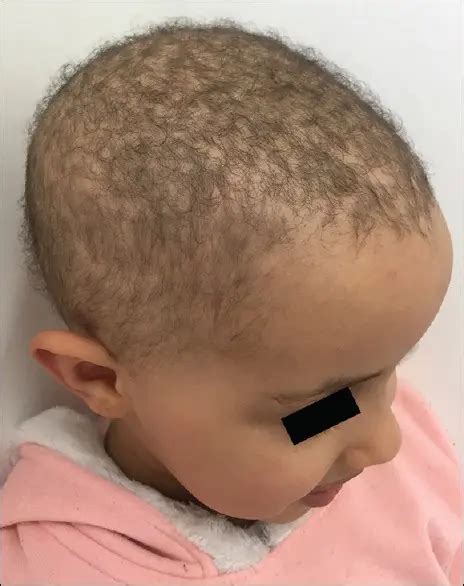 Loose Anagen Syndrome What It Is Symptoms And Treatments