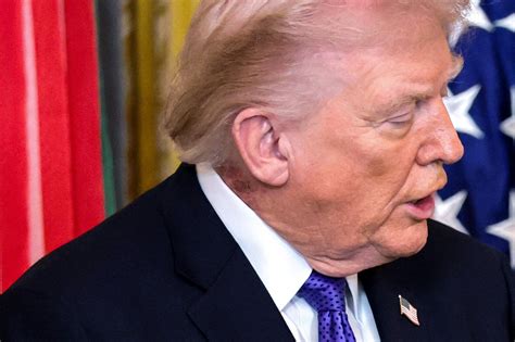Images Show Rash On President Trumps Neck What Is It Nation