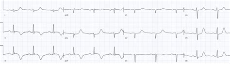 The Ecg In The Diagnosis Of Aortic Dissection Ecg Cases Em Cases