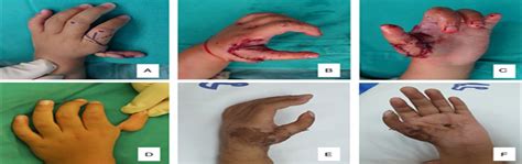 Vascularized Toe Joint Transfer For Hypoplastic Thumb Type I