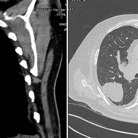 Ct Scan Showing Multiple Centrilobular Nodules In The Upper Lung Zone Download Scientific