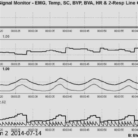A Dysfunctional Breathing Pattern In A Young Man With Frequent Seizures