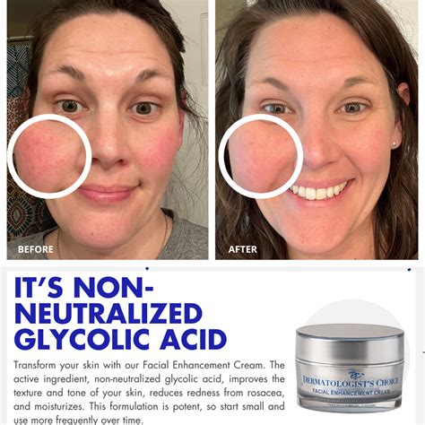 Glycolic Acid Heres Why Those Initial Bumps Are Your Passport To A F