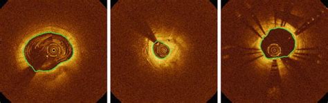 Image Processing In Intravascular OCT Ento Key