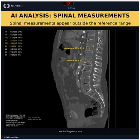 Healthost Vertebral Compression Fractures Ferrum Health