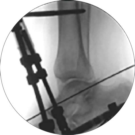 Techniques In Deformity Correction Compendium Of Tsf Applications