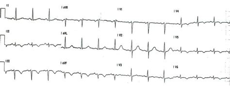 Pseudonormalization Of Inferior T Waves Dr Smiths Ecg Blog