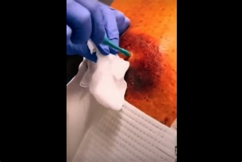 Large Infected Cyst Explosion New Pimple Popping Videos