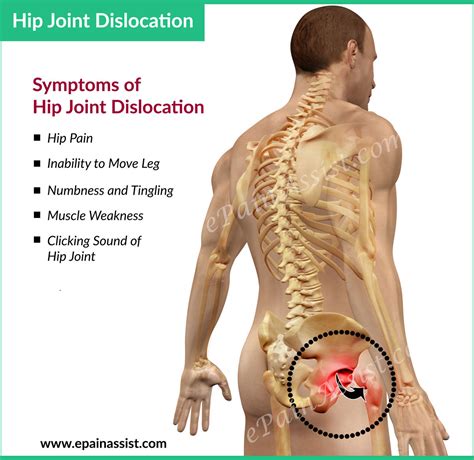What Is Hip Dislocation Types Treatment Exercises For Hip Dislocation