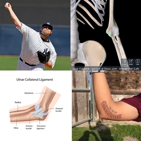 Ulnar Collateral Ligament Reconstruction