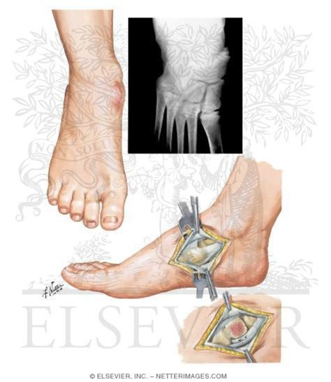 Accessory Navicular