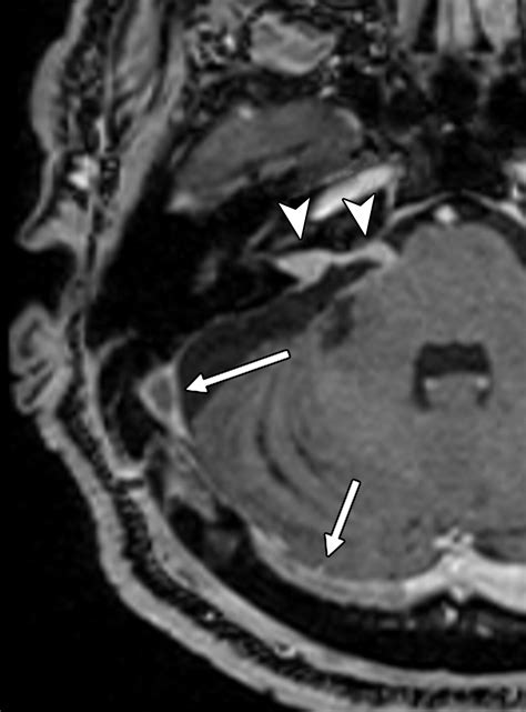 Postoperative Imaging Of The Temporal Bone Radiographics