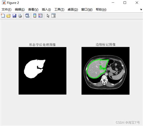 【第 26 章 基于最小误差法和区域生长的医学影响分割系统 matlab深度学习实战gui项目】 基于matlab gui的医用系统开发 csdn博客