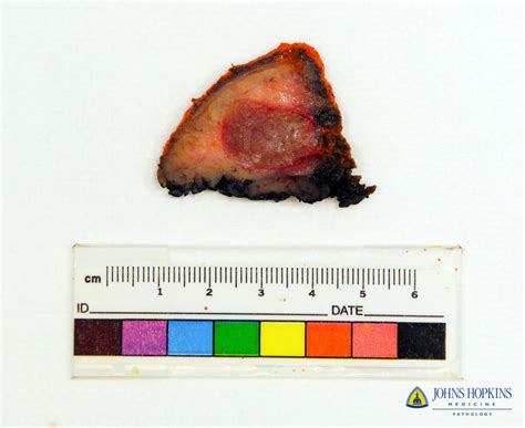 Warthin Tumor Surgical Pathology Photo Website