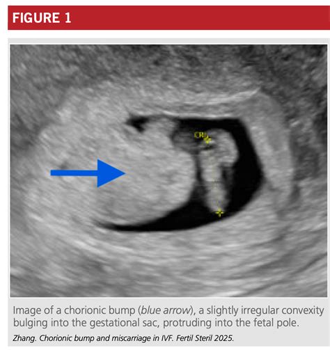 Chorionic Bumpが認められた場合、妊娠初期の流産リスクは高まるが、それを乗り越えれば 両角 和人（生殖医療専門医）のブログ