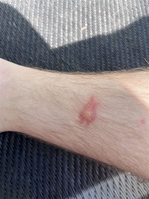 Can Anyone Identify This Bug Bite Rcincinnati