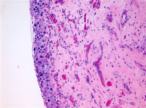 Pathology Outlines Carcinoma In Situ