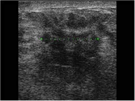 Breast And Axilla 52 Malignant Breast Lesions Case 5213