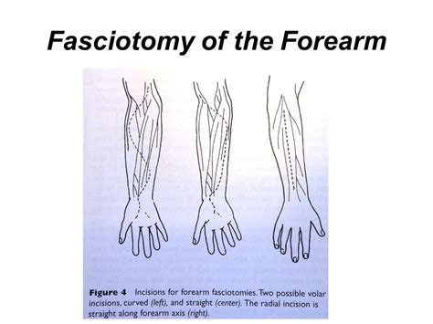 Compartment Syndrome And Fasciotomy Ppt Download