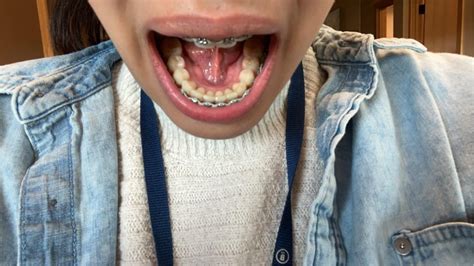 4 Month Difference On My Bottom Teeth Rbraces