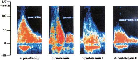 Characterization Of Doppler Waveform At Different Zones Along The