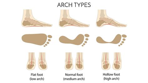 Yim Physio Near Me Flat Feet Vs Neutral Vs High Arch How To Do