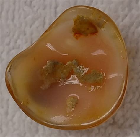 Global Prosthetics—prosthetic Eye Care