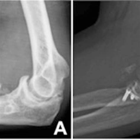 Binary Lego Description System Of The Hertel Classification Of