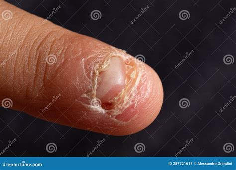 Missing Fingernail