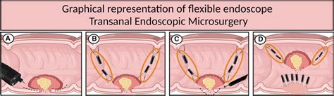 A Starting The Resection Using The Classic Steps Of Endoscopic