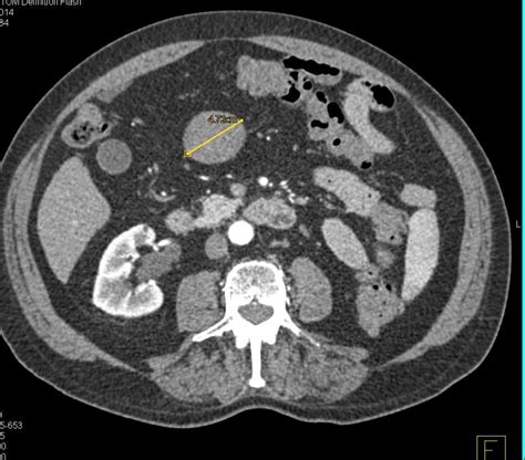 Exophytic Gastric Gist Tumor Stomach Case Studies Ctisus Ct Scanning