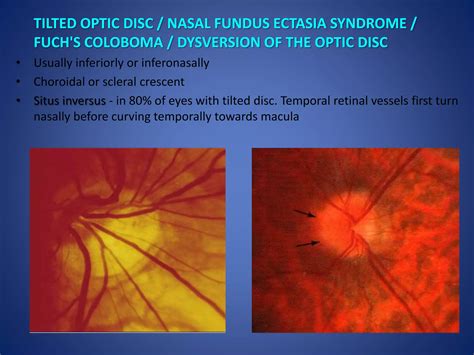 Optic Disc Evaluation Pptx