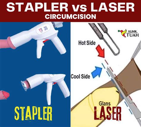 Stapler Vs Laser Circumcision The Ultimate Showdown