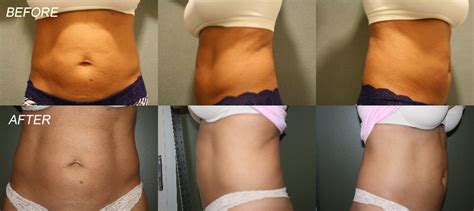 Radio Frequency Body Contouring Nyc Rejuvenation Clinic