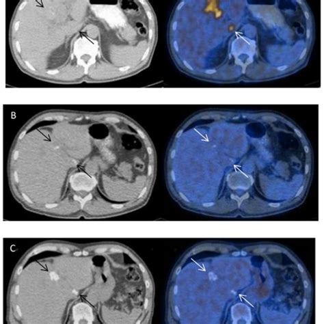 Chest X Ray Showing Bilateral Diffuse Micronodules And Ground Glass Download Scientific Diagram