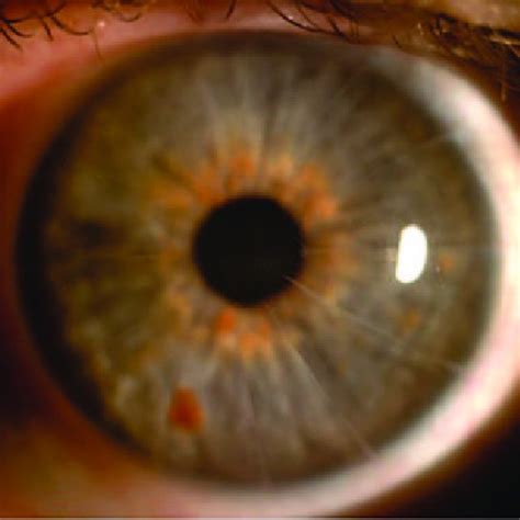 Subepithelial Fibrosis Is Visualized In The Optical Center Of The