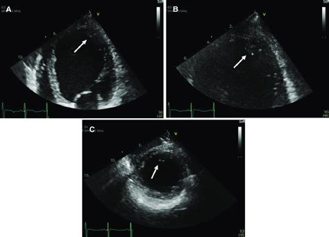 Transthoracic Echocardiography Images Following The Stemi Raised The