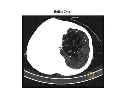 Differential Diagnosis Of Pulmonary Cyst 1 Bullous Emphysema 2 Cystic Bronchiectasis 3