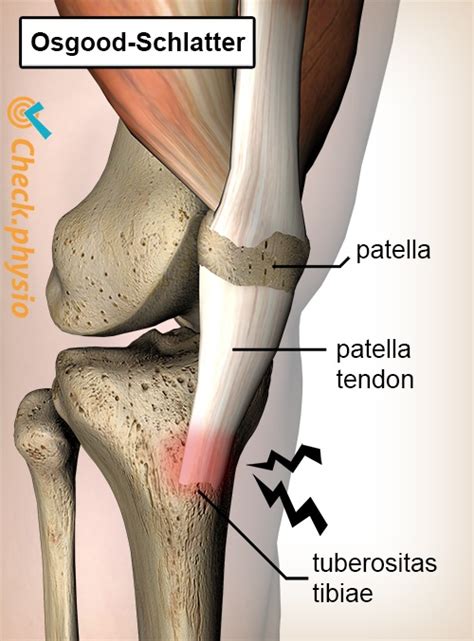 Osgood Schlatter Cause Symptoms And Treatment