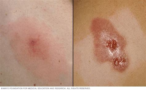 Staph Infection Mayo Clinic