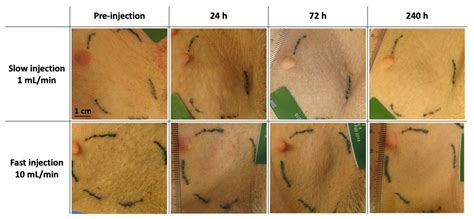 Subcutaneous Injection Technique