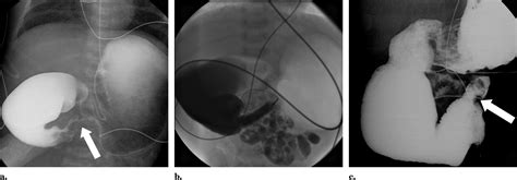 Balloon Dilation Of Postoperative Small Bowel Stricture In An Infant Journal Of Vascular And